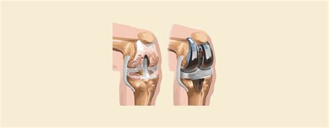 Amputation Vs Limb Salvage Understanding The Differences Knya