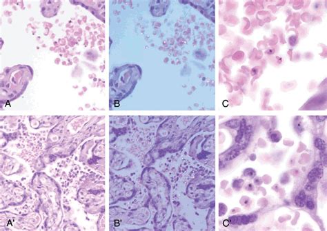 Comparison Between Plasmodium Vivax A B And C And Plasmodium