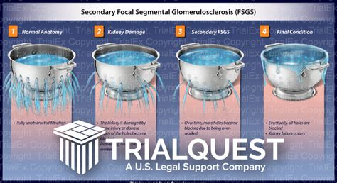 Secondary Focal Segmental Glomerulosclerosis Fsgs Trialquest