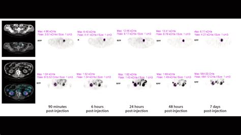 Tumor And Organ Dosimetry From Sequential Quantitative Spect Ct