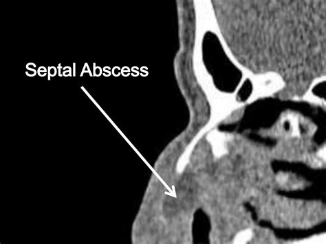 Clinical Procedures Septalauricular Hematoma Pptx