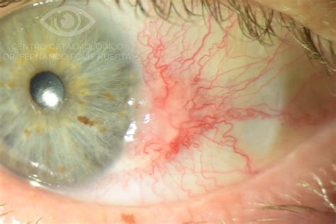 Neoplasia Escamosa De Superficie Ocular Neso Atlas De Oftalmología