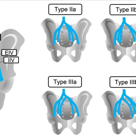 Variations In The Branching Pattern Of The Internal Iliac Vein Ivc