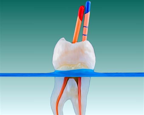 Root Canal Treatment Side Effects Reviews And Prices 2025
