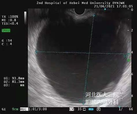 分享一例胰腺假性囊肿的ercp治疗 胆胰内镜网