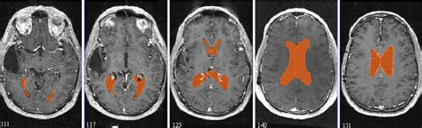 The 3d Segmentation Of Brain Ventricles From A Single Time Point Of A Download Scientific