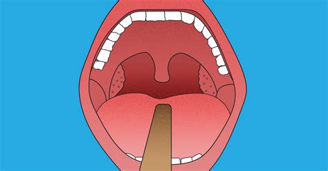A Person Without Tonsils
