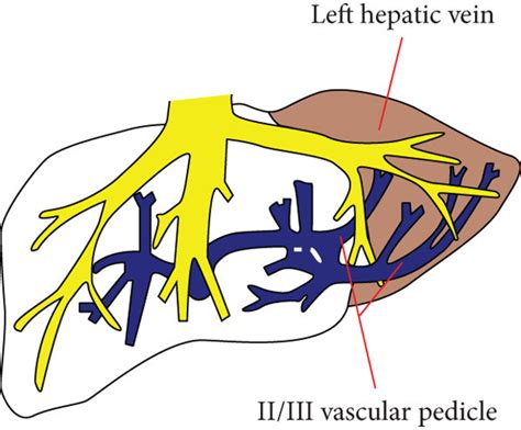 A The “five Step” Single Port Laparoscopic Hepatic Left Lateral Download Scientific Diagram