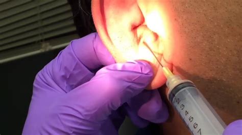 Aspiration Of Auricular Hematoma Cauliflower Ear Enta