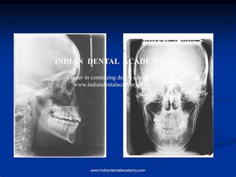 Cephalometry 2 Certified Fixed Orthodontic Courses By Indian Dental