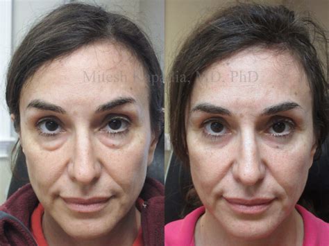 Lower Eyelid Surgery In Massachusetts Boston Eyelid Surgery