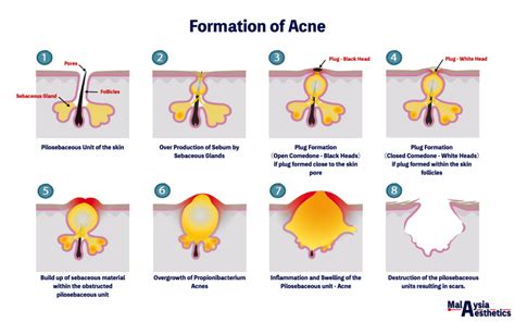 Acne Treatment Malaysia Acne Treatment Options Malaysia Aesthetic