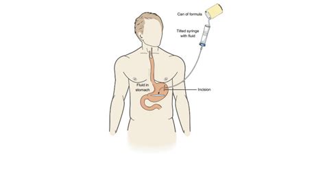 Nutrición Enteral Tipos Definición Y Usos Con Pacientes