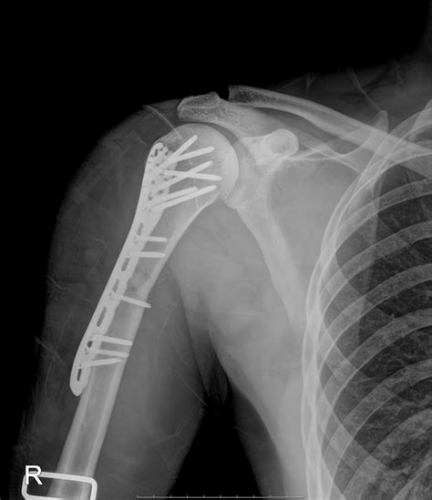 Compression Fracture Arm