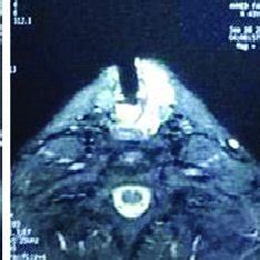 MRI Shows Diffuse Enlargement Of The Thyroid Gland More Evident At The Download Scientific