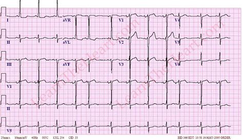 premature atrial contractions ekg my xxx hot girl
