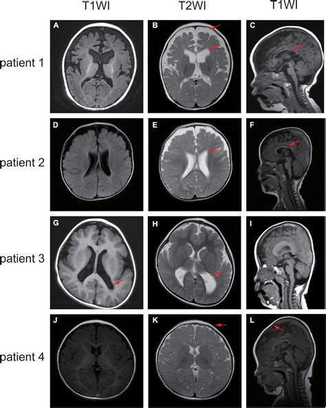 Enlarged Ventricles Brain Mri