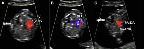 First Trimester Fetal Echocardiography Identification Of Cardiac