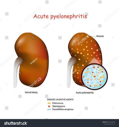 Acute Pyelonephritis Over 99 Royalty Free Licensable Stock Vectors And Vector Art Shutterstock