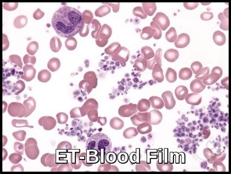 Essential Thrombocythemia Ask Hematologist Understand Hematology