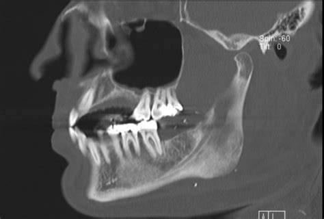 Temporomandibular Joint Dislocation Following Pterygomasseteric Myotomy And Coronoidectomy In