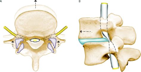 Left Lateral Recess Stenosis