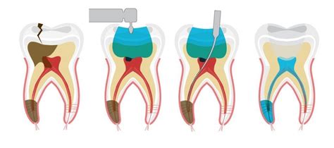 Endodoncia Matar El Nervio Cómo Se Hace Y Cuándo Es Necesario