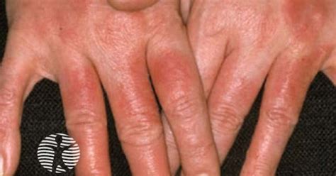 Hand Dermatitis Image