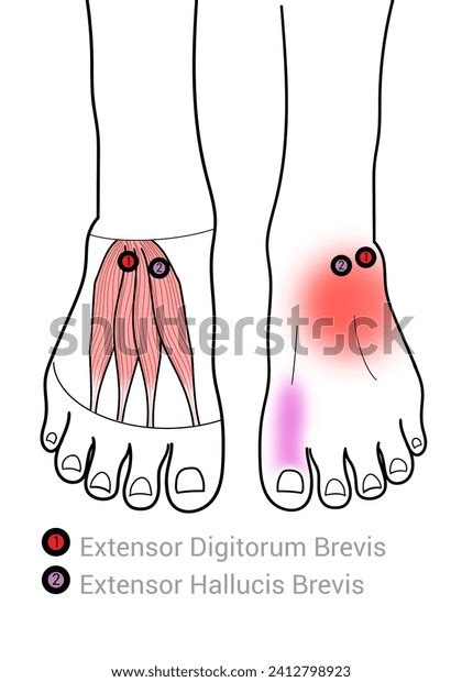 Myofascial Trigger Point Extensor Digitorum Brevis Stock Illustration 2412798923 Shutterstock