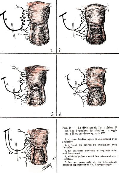 Image Of Varieties Ofthe Uterine Artery