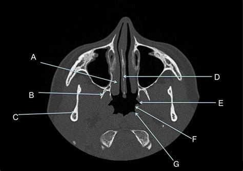 Cranial Bone Anatomy Ct Axial