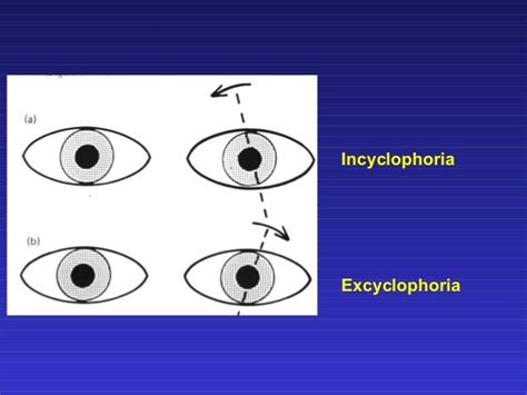 Heterophoria2