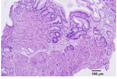 Pathological Findings Of Gastric Polypoid Lesions Pathology Revealed