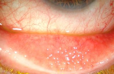 Giant Papillary Conjunctivitis