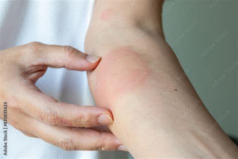 Young Asian Man Itching And Scratching On Arm From Allergic Itchy Dry Skin Eczema Dermatitis