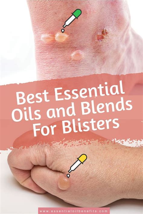 Essential Oil For Blisters Artofit