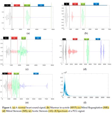 Brief Review — Classification Of Heart Sound Signal Using Multiple