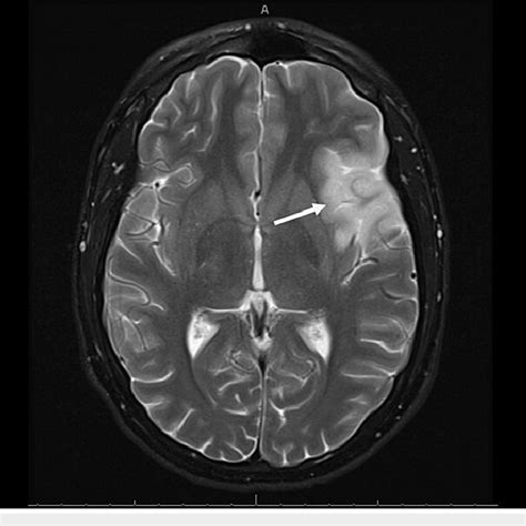 Axial Diffuse Weighted Image Sequences From Mri Of The Brain Arrow Download Scientific Diagram