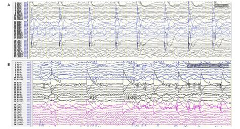 a high amplitude low frequency periodic spikes this patient
