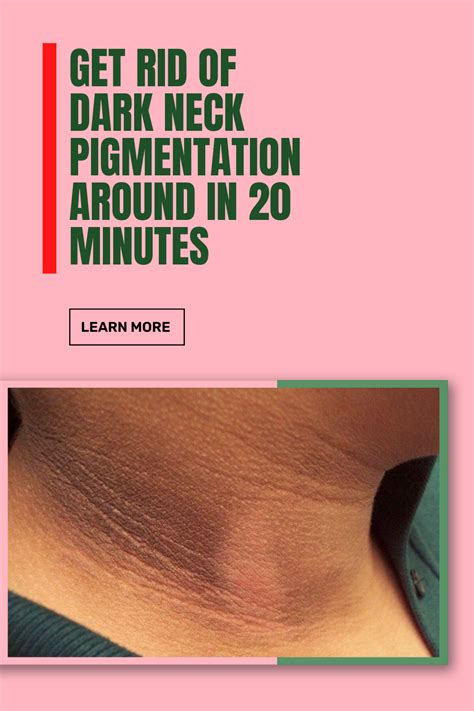 Causes Of Hyperpigmentation On Neck Neck Hyperpigmentation Dark