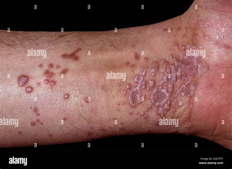 Lichen Planus Lesions On The Wrist Of A 43 Year Old Male Patient With