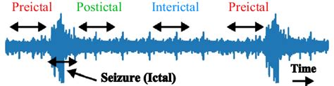 Different Eeg Signal Phases In Epileptic Patients Download Scientific