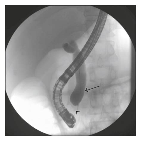 A ERCP With Cholangiogram Showing Dilated Common Bile Duct Pointed Download Scientific