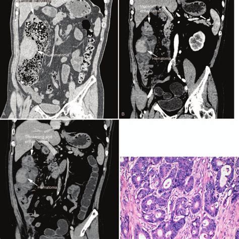 Histology Of The Colon Cast Showing Necrotic Fibrinopurulent Exudate