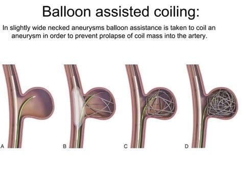 Endovascular Neurosurgery Ppt