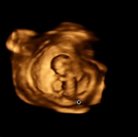 임신 11주 아기 심장 소리 아기 크기 1차 기형아 검사 태아정밀초음파목투명대검사 입체초음파 태교 여행 네이버 블로그