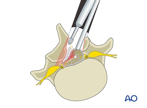 Microscopic Tubular Unilateral Laminotomy For Bilateral Decompression