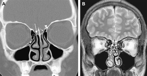 A Coronal Ct Section Through The Level Of Anterior Orbits