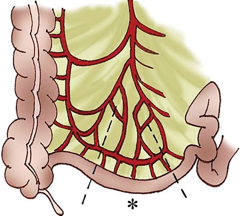 What Is A Cystoprostatectomy With Ileal Conduit At Ethan Fuhrman Blog