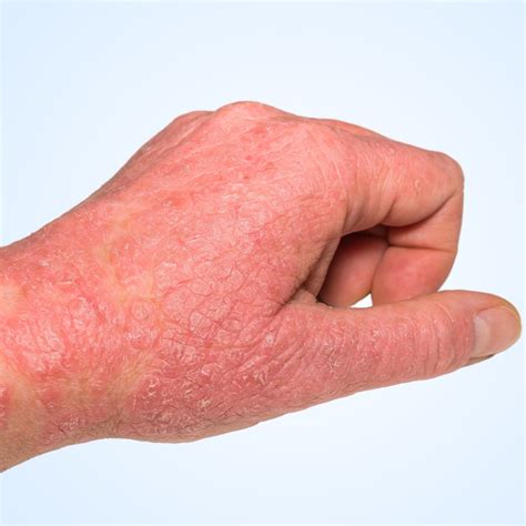 Doctors Note Your Essential Guide To Hand Dermatitis